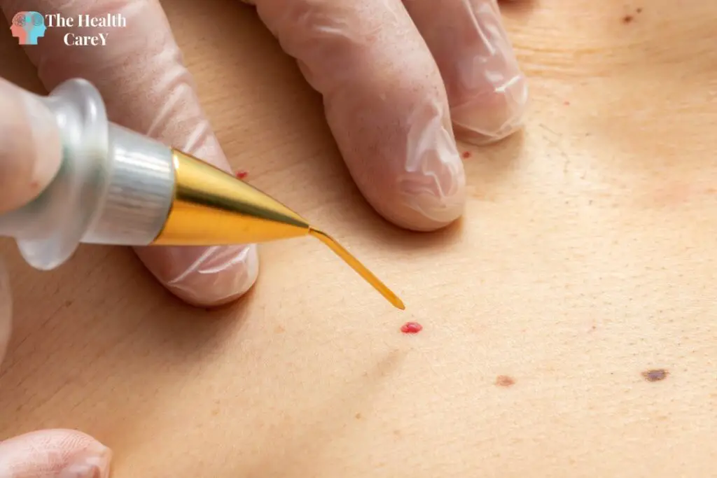 How to Get Rid of Cherry Angiomas at Home: Effective Home Remedies ...