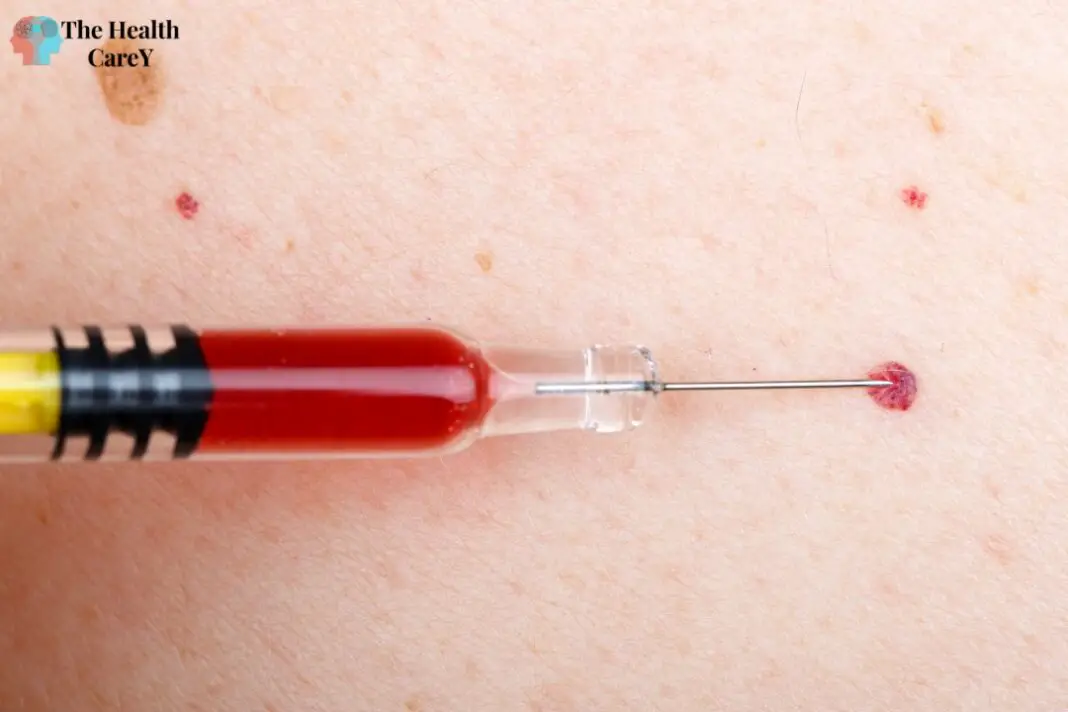 How to Get Rid of Cherry Angiomas at Home: Effective Home Remedies ...